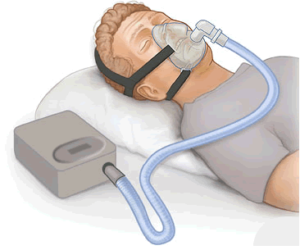 Συσκευές Άπνοιας CPAP ΕΟΠΥΥ - ΟΞΥΓΟΝΟΘΕΡΑΠΕΙΑ - ΙΑΤΡΙΚΟ ΟΞΥΓΟΝΟ ΣΤΟ ΣΠΙΤΙ